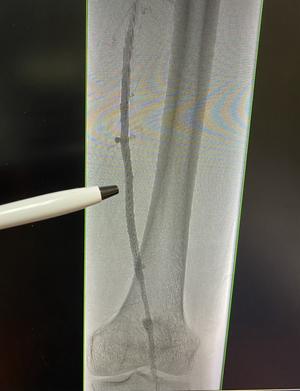 Meet patient Roy | HCA Florida